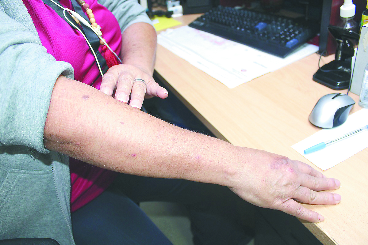 Esas manchitas en su piel, podrían ser púrpura senil - Panorama Católico